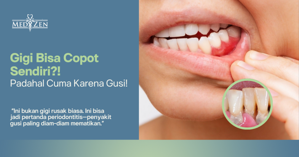 Waspadai Periodontitis: Penyakit Gusi yang Bisa Bikin Gigi Copot Tanpa Dicabut! - Medizen Clinic